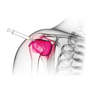 Capsulite - L'épaule au TOP