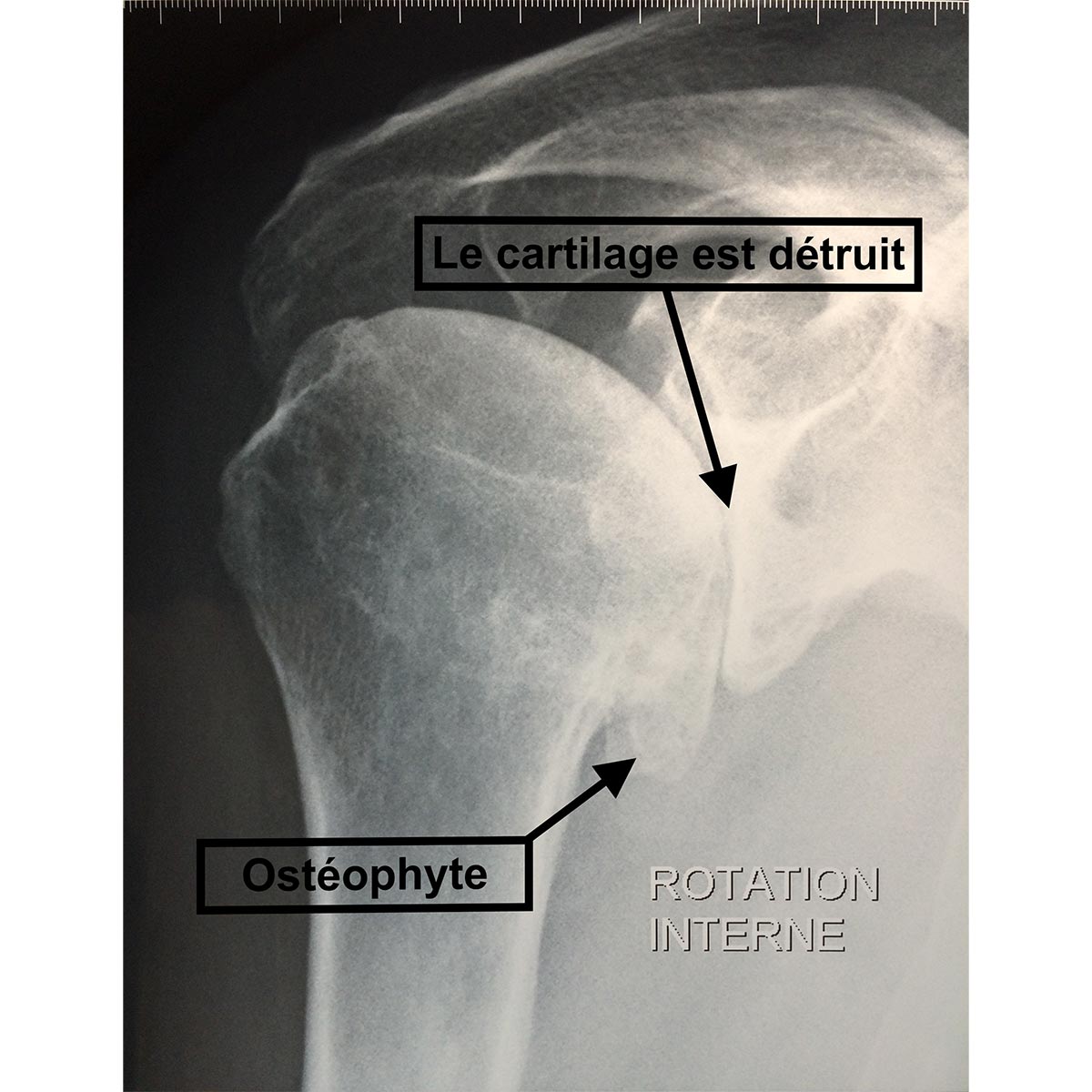 Arthrose - L'épaule au TOP