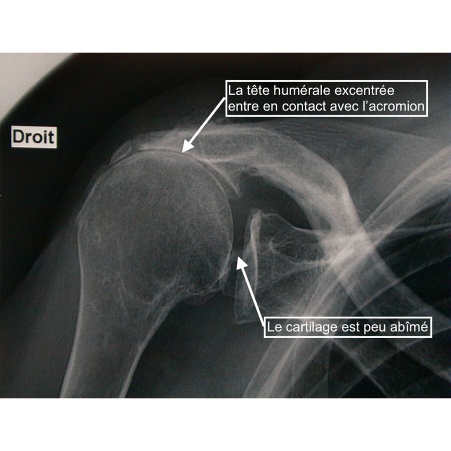 Arthrose - L'épaule au TOP