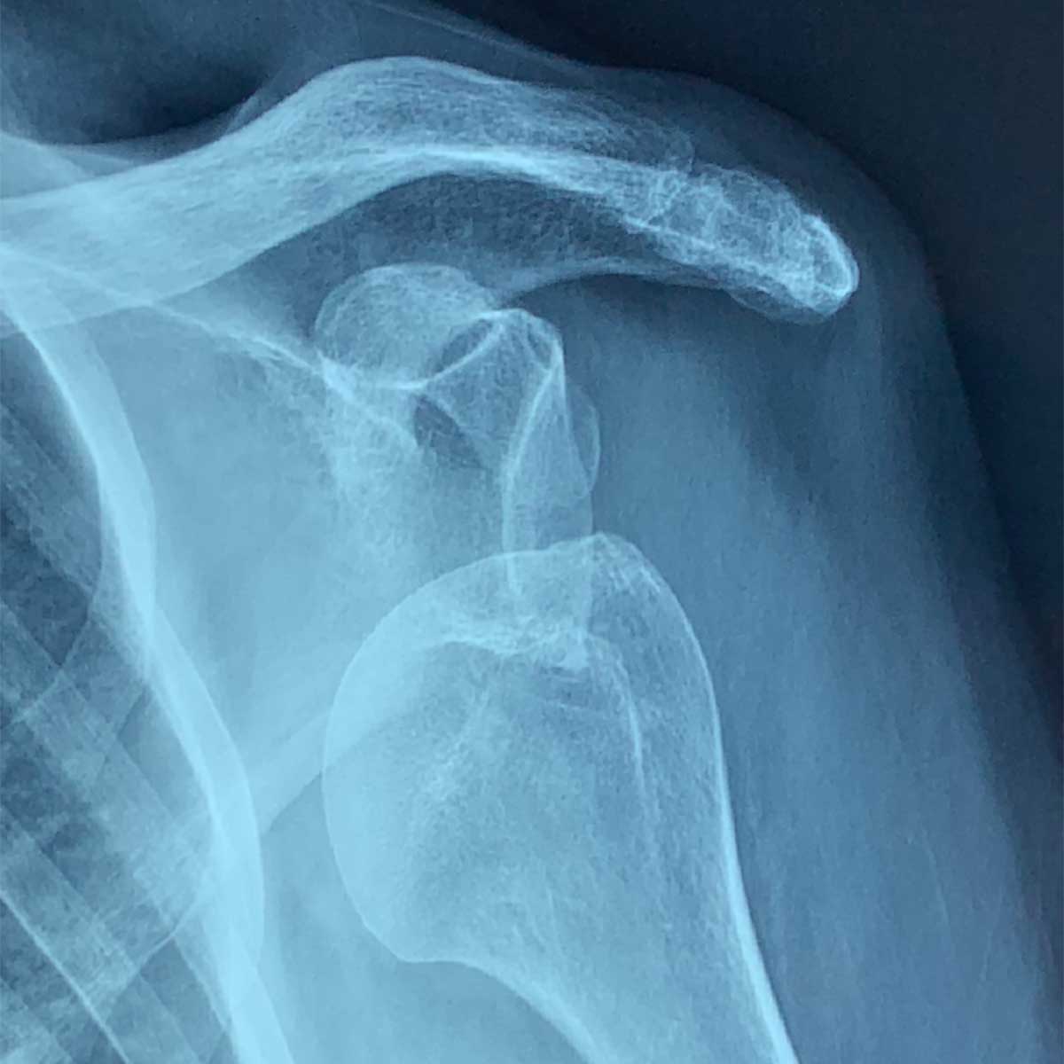 Instabilité - L'épaule au TOP